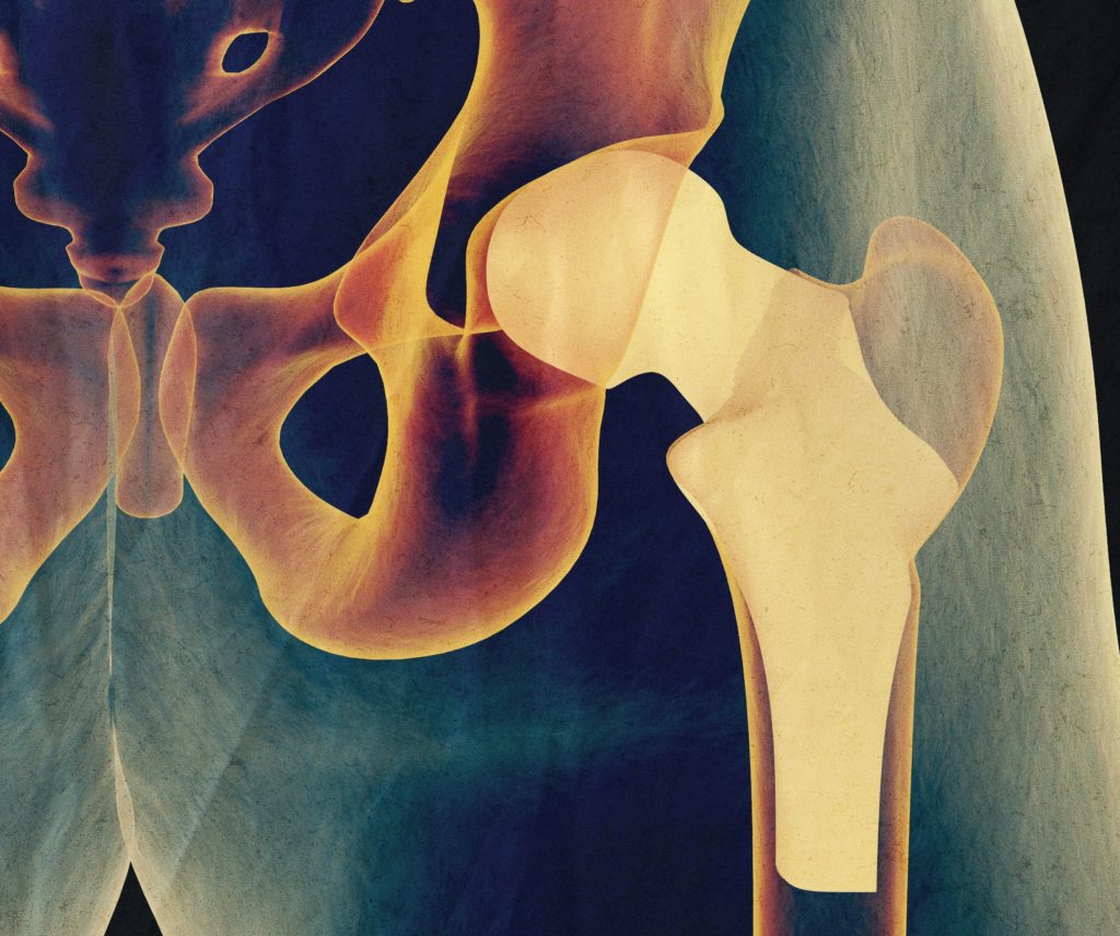 Joint Replacement - Wilson Orthopaedics & Sports Medicine
